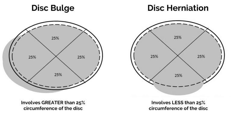 Can You Deadlift With a Herniated Disc? | Barbell Rehab