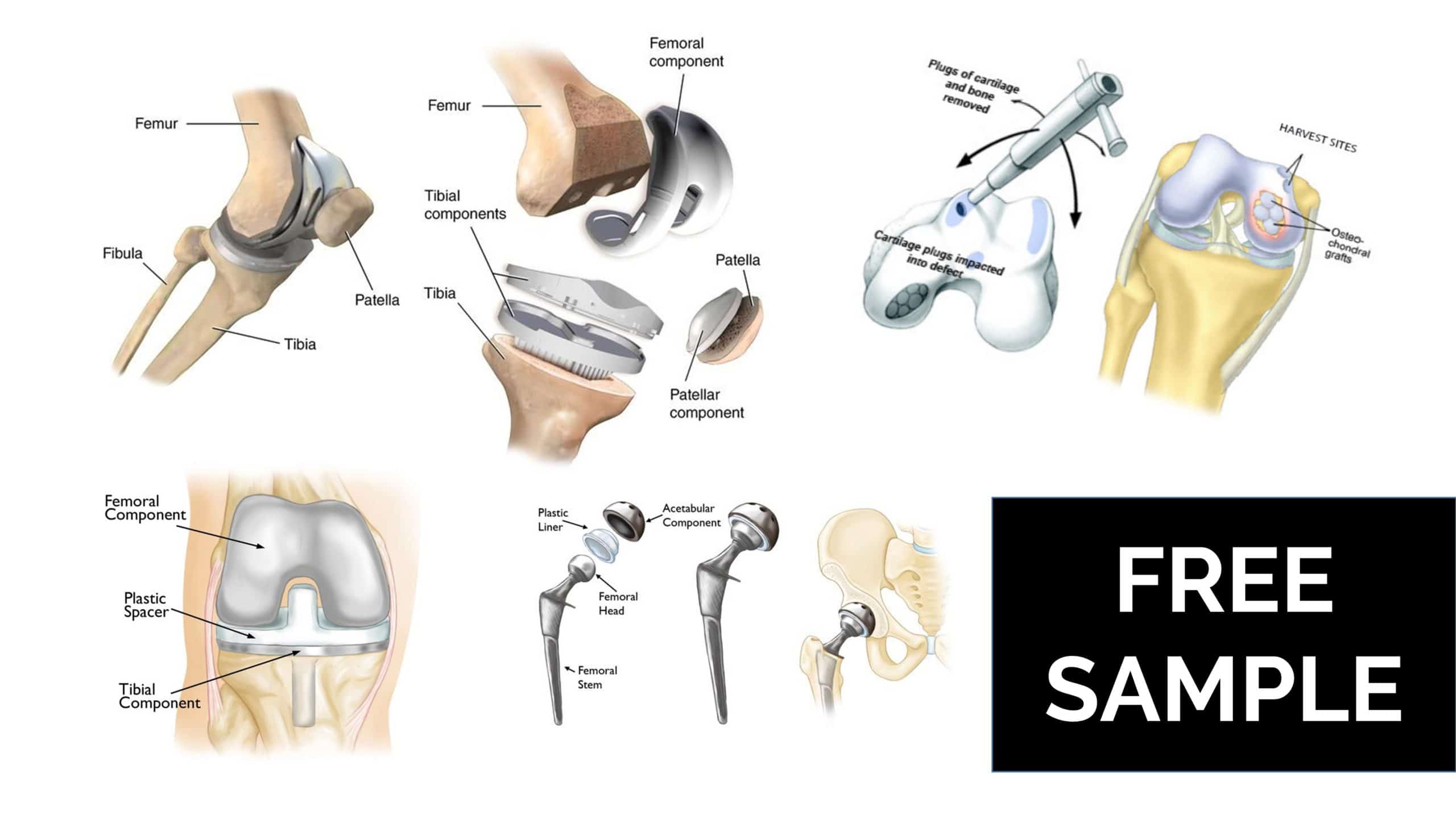 Strength Training the Post-Operative Client Free Sample